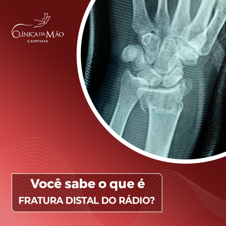 Você sabe o que é fratura do terço distal do rádio? - Clínica da Mão - 2021