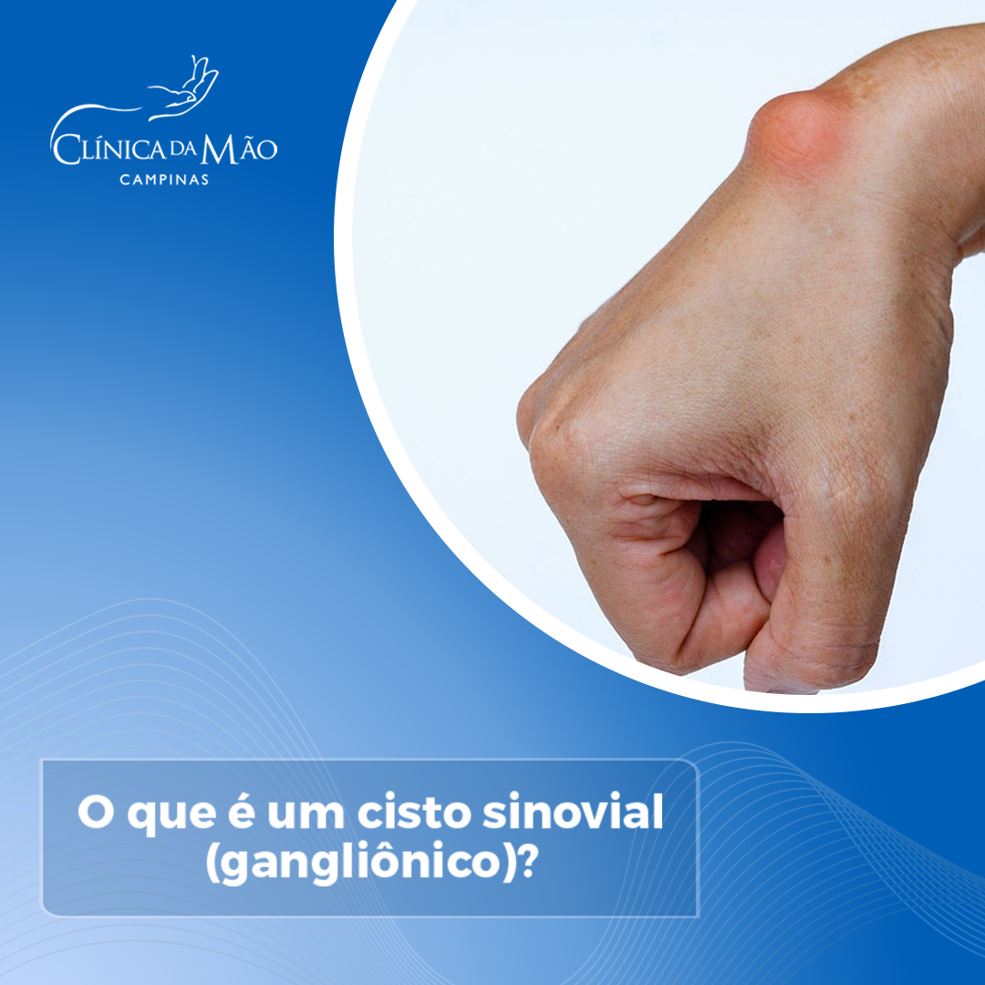 O que é um cisto sinovial (gangliônico)? - Clínica da Mão - 2021