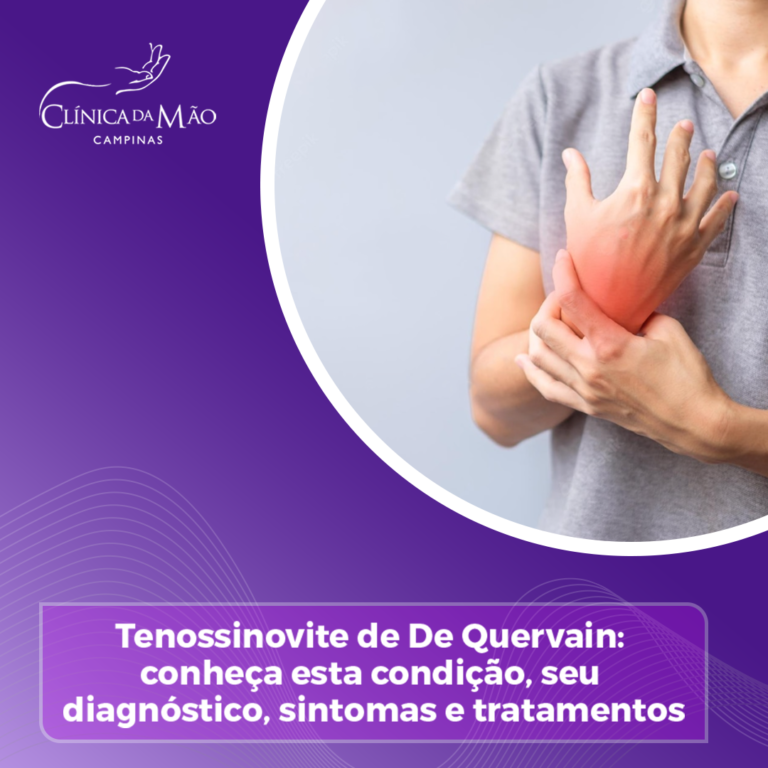 Tenossinovite de De Quervain: conheça esta condição, seu diagnóstico ...